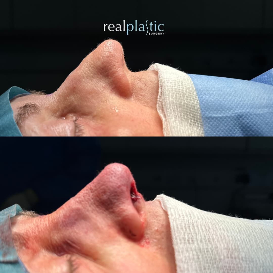 Septorhinoplasty Surgery in London | Real Plastic Surgery