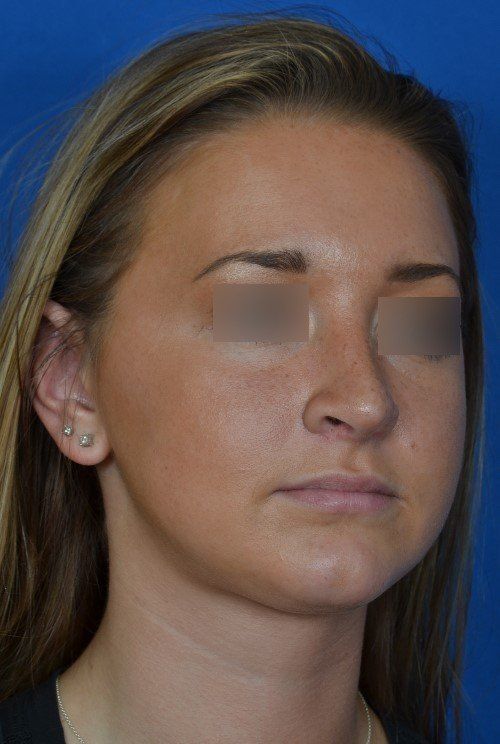 Nostril Reshaping Rhinoplasty Explained