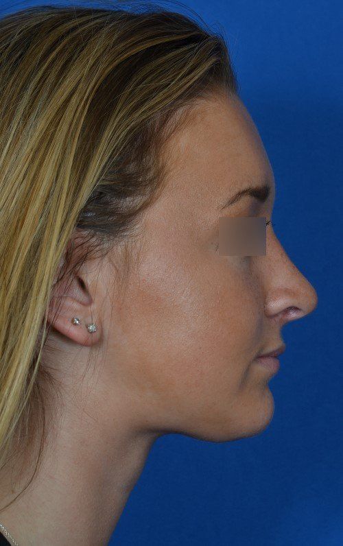 Nostril Reshaping Rhinoplasty Explained