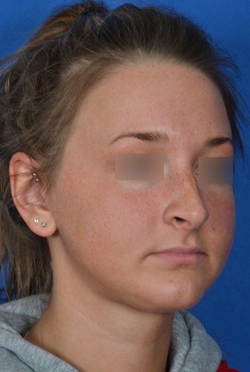 Nostril Reshaping Rhinoplasty Explained