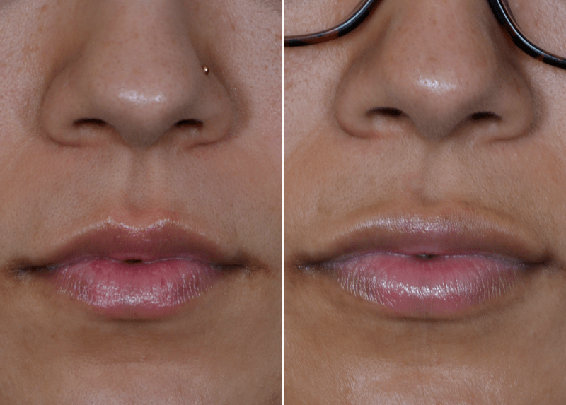 Facial Implants: The Permanent "Filler"
