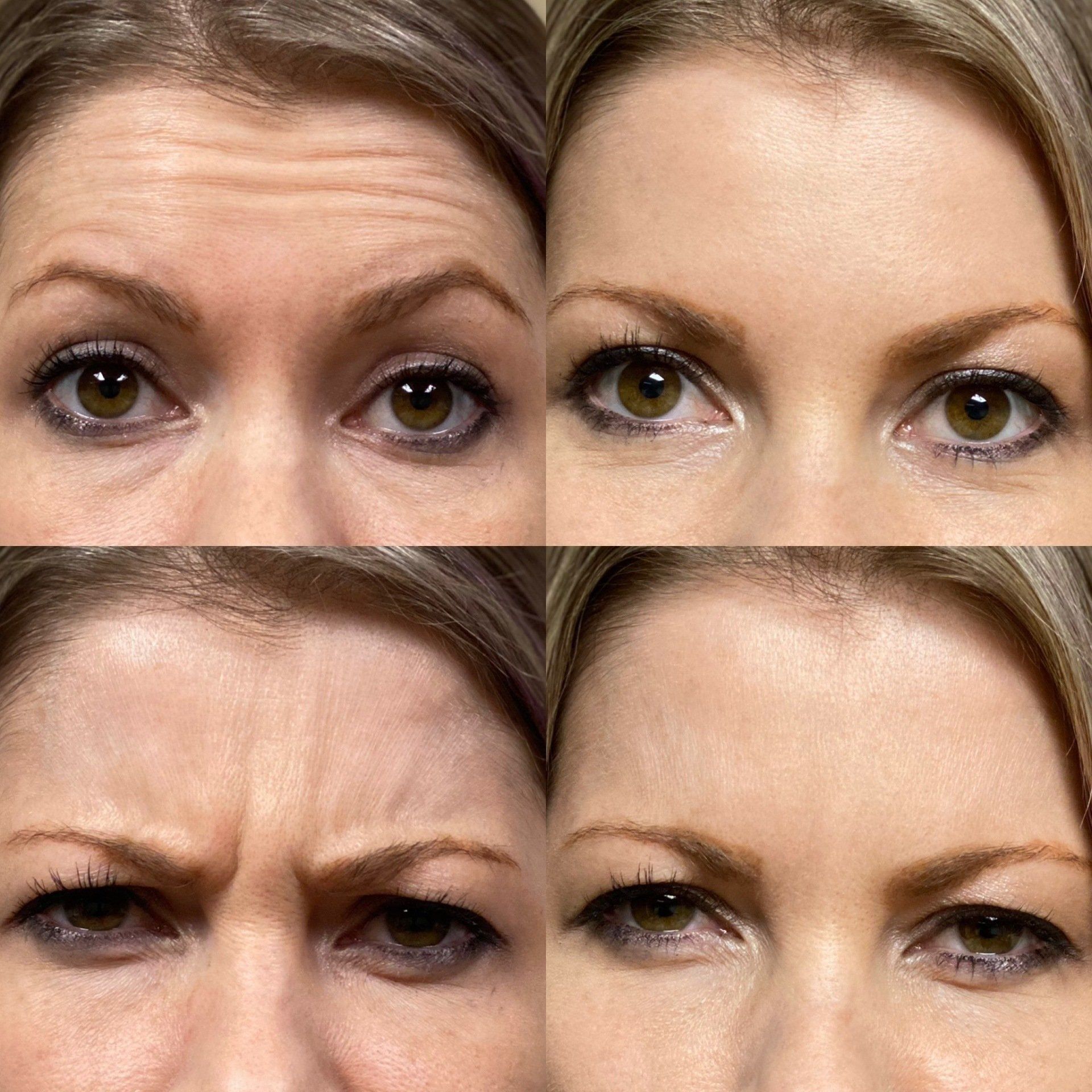 Dynamic Vs Static Wrinkles What Are The Treatments 