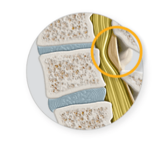 Mild Procedure I AVORS Medical Group