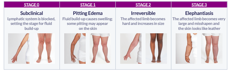 Lymphoedema Dermnet Nz Common Skin Issues Mind The Bleep