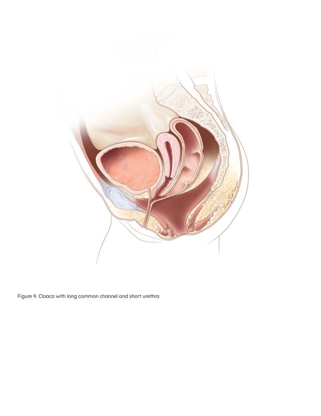 persistent cloaca in males