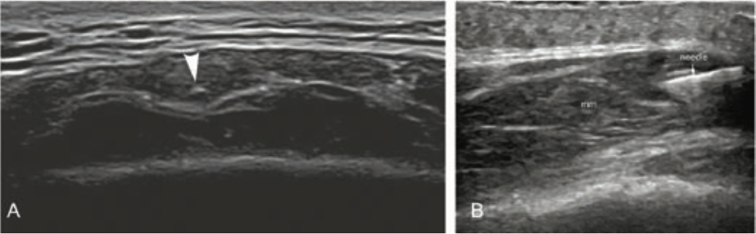 Masseter Muscle Botox injections – the new clinical protocol