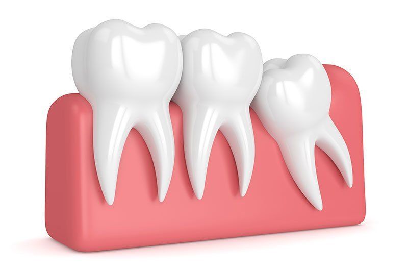 Learn About Wisdom Teeth Extractions And If You May Need One