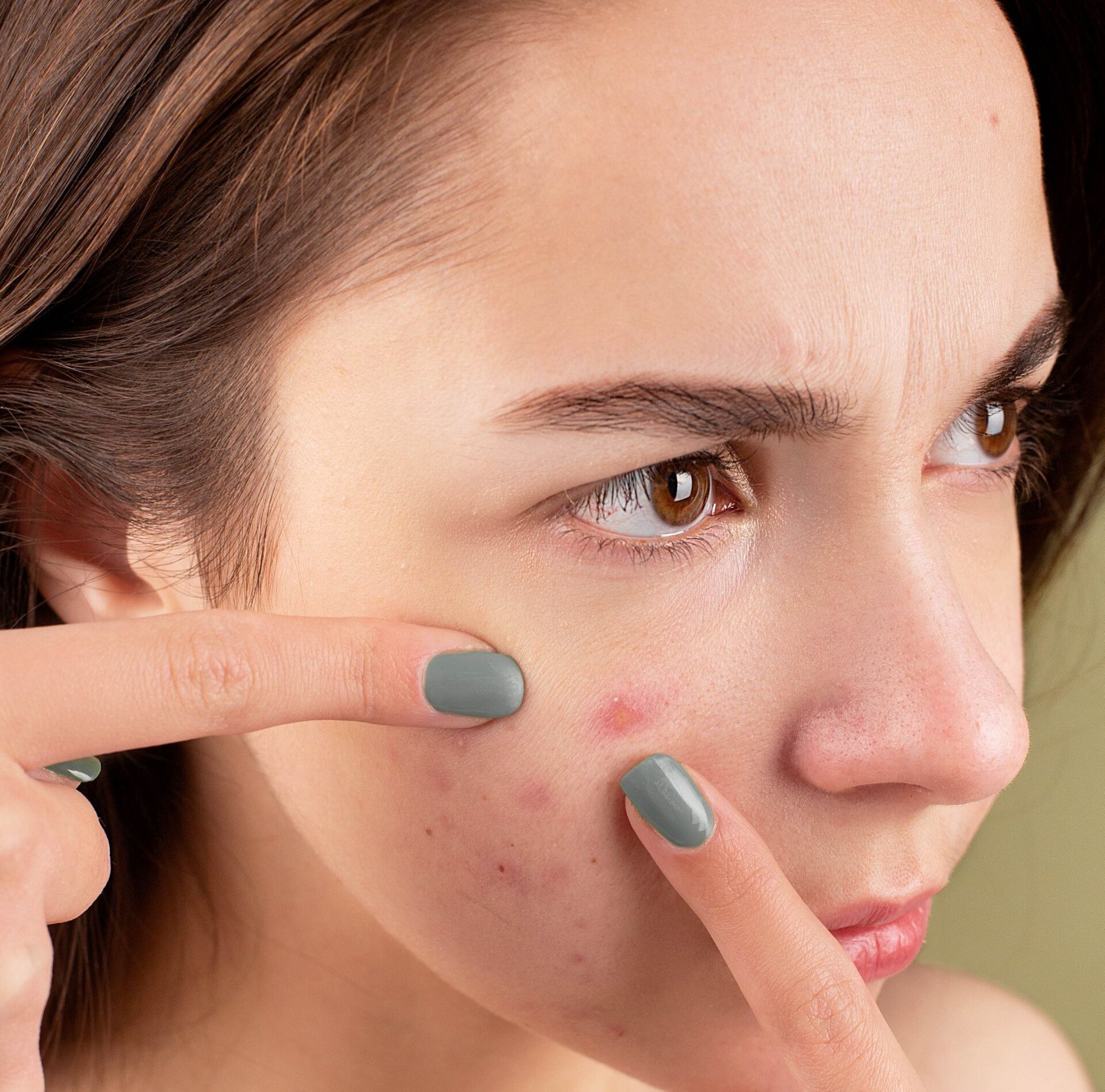 Canadian Acne Guidelines | 2025 Updates | Information