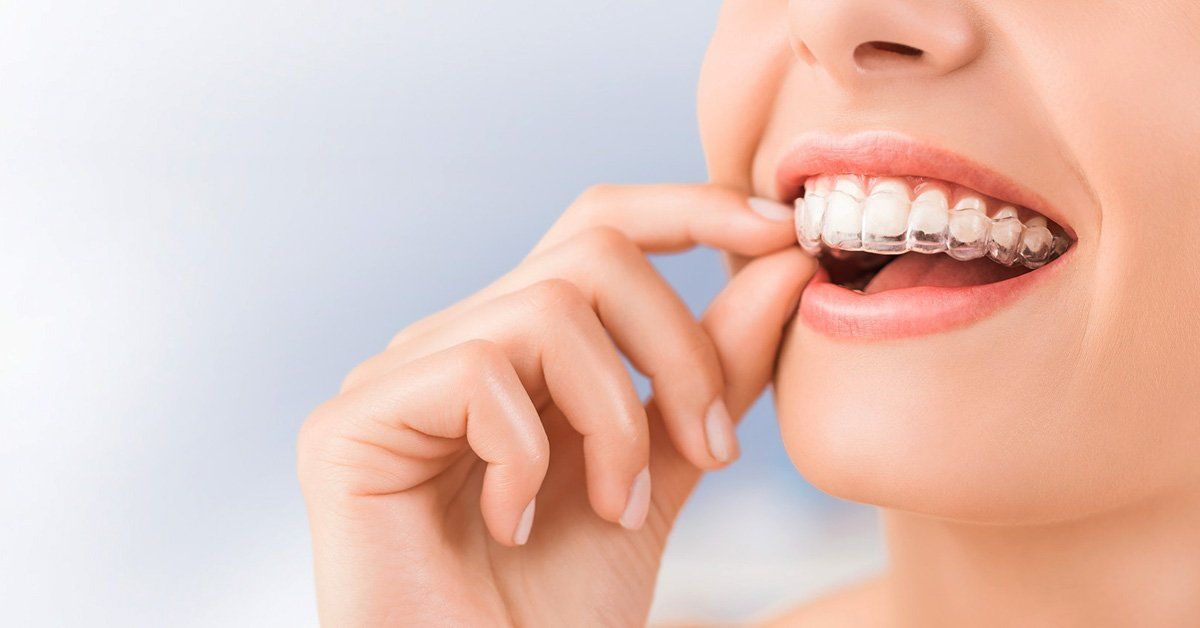 Invisalign A Step By Step Guide To The Process Of Straight Teeth