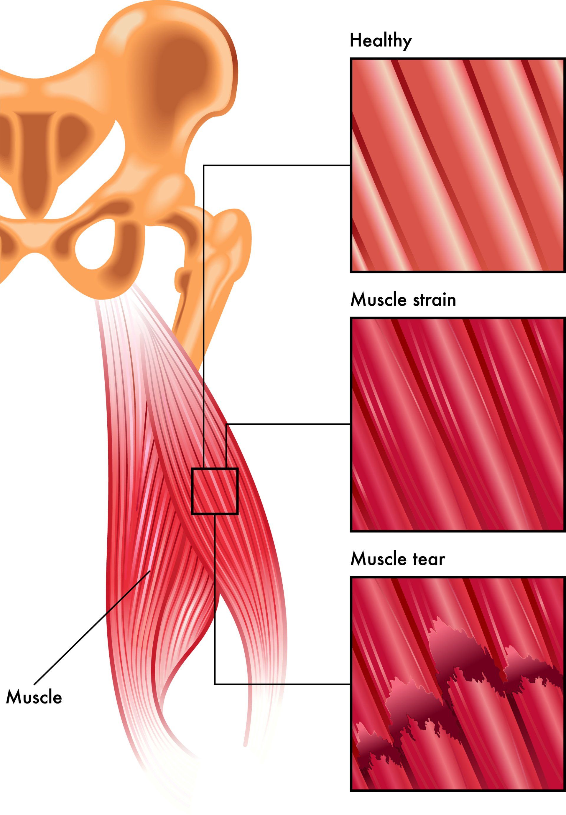 All About Muscles, Tendons and Ligaments