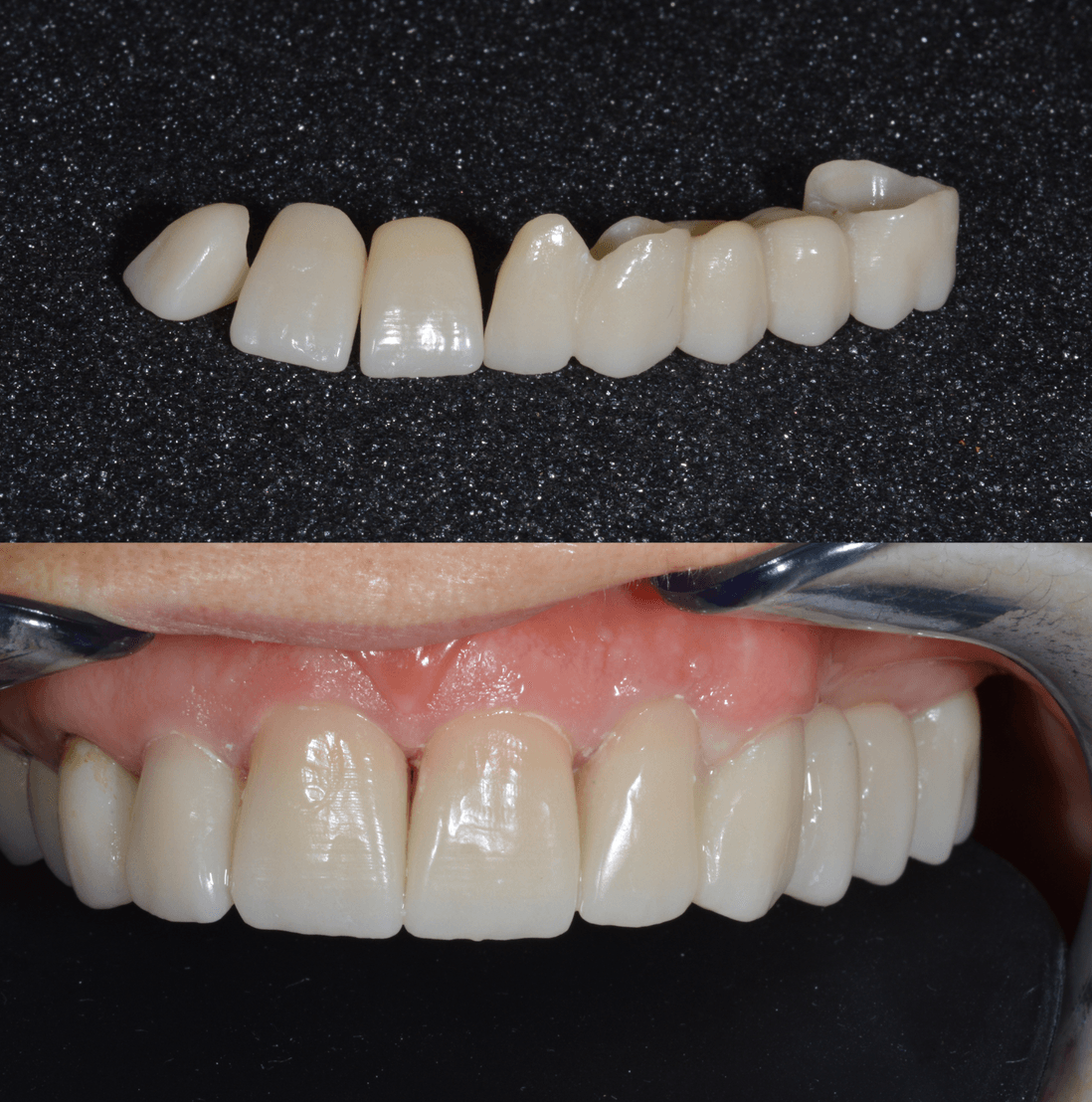 PMMA (polimetilmetakrilāta ) pagaidu kroņi ilgstošai lietošanai