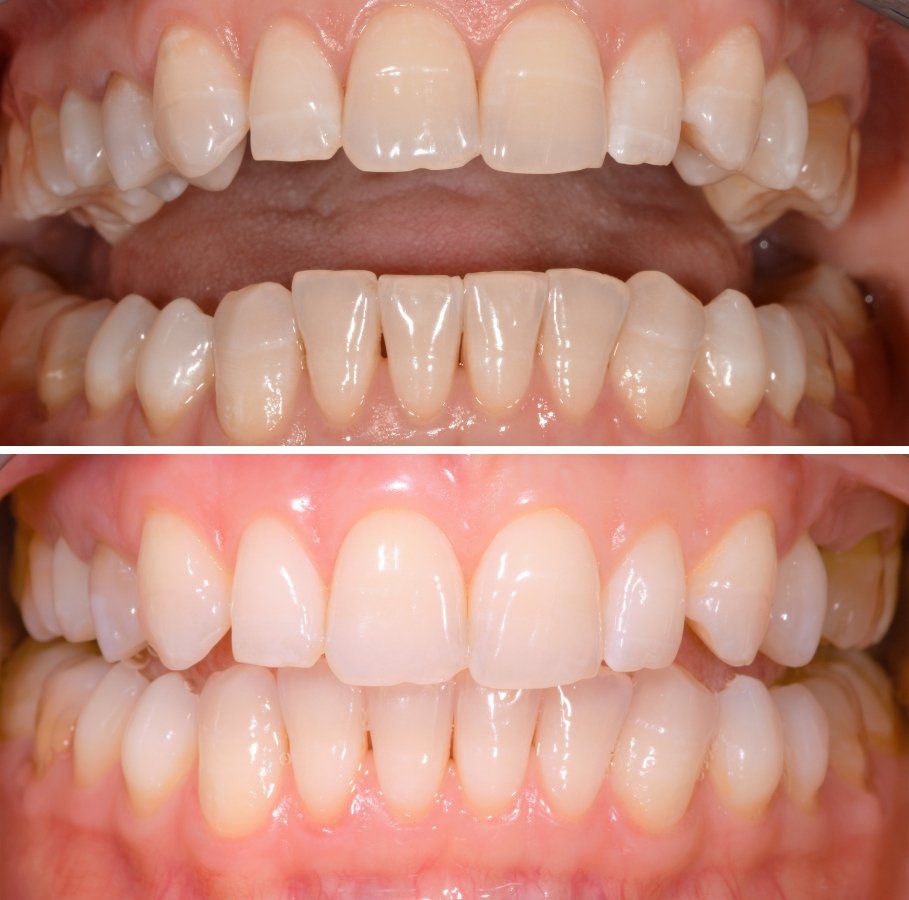 Kāpēc zobu balināšana zobārstniecības krēslā?