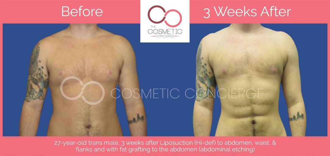 Gallery | High-Def Liposuction/Muscle Etching | The Cosmetic Concierge ...