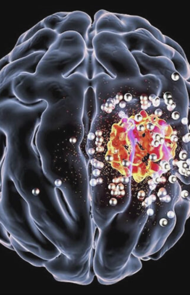 Glioblastoma Multiforme: O que São, Sintomas e Tratamento