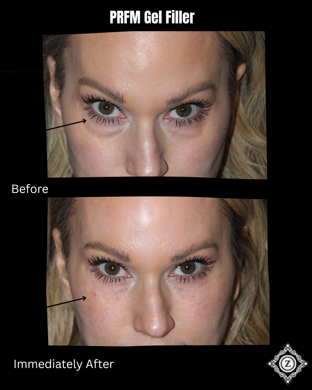 PRP Filler for Natural Rejuvenation | Baton Rouge | Z Derm