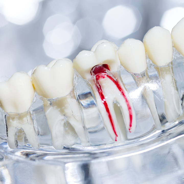 When Is a Root Canal the Right Choice? Understanding Endodontic Therapy ...