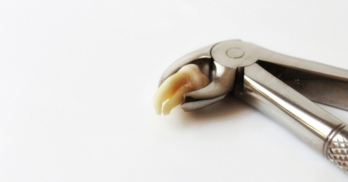 Tooth Extractions: A Complete Guide
