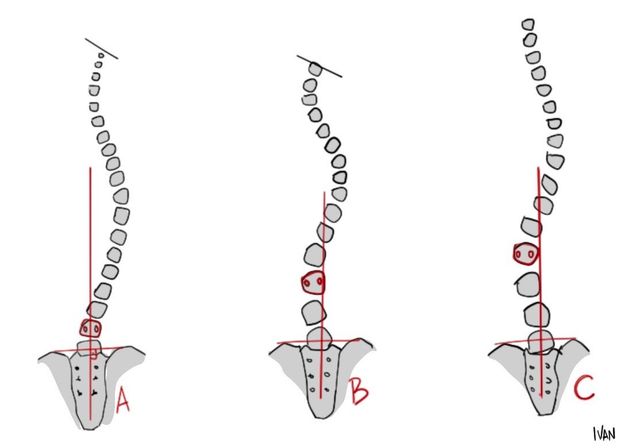 Escoliose De Risser Conhece O Sinal De Risser? – GAOT