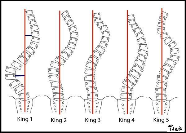 Escoliose De Risser Conhece O Sinal De Risser? – GAOT