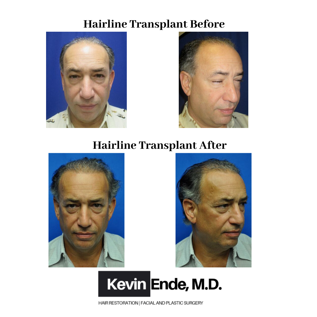 Facelift | Englewood, NJ | Dr. Kevin Ende, M.D.