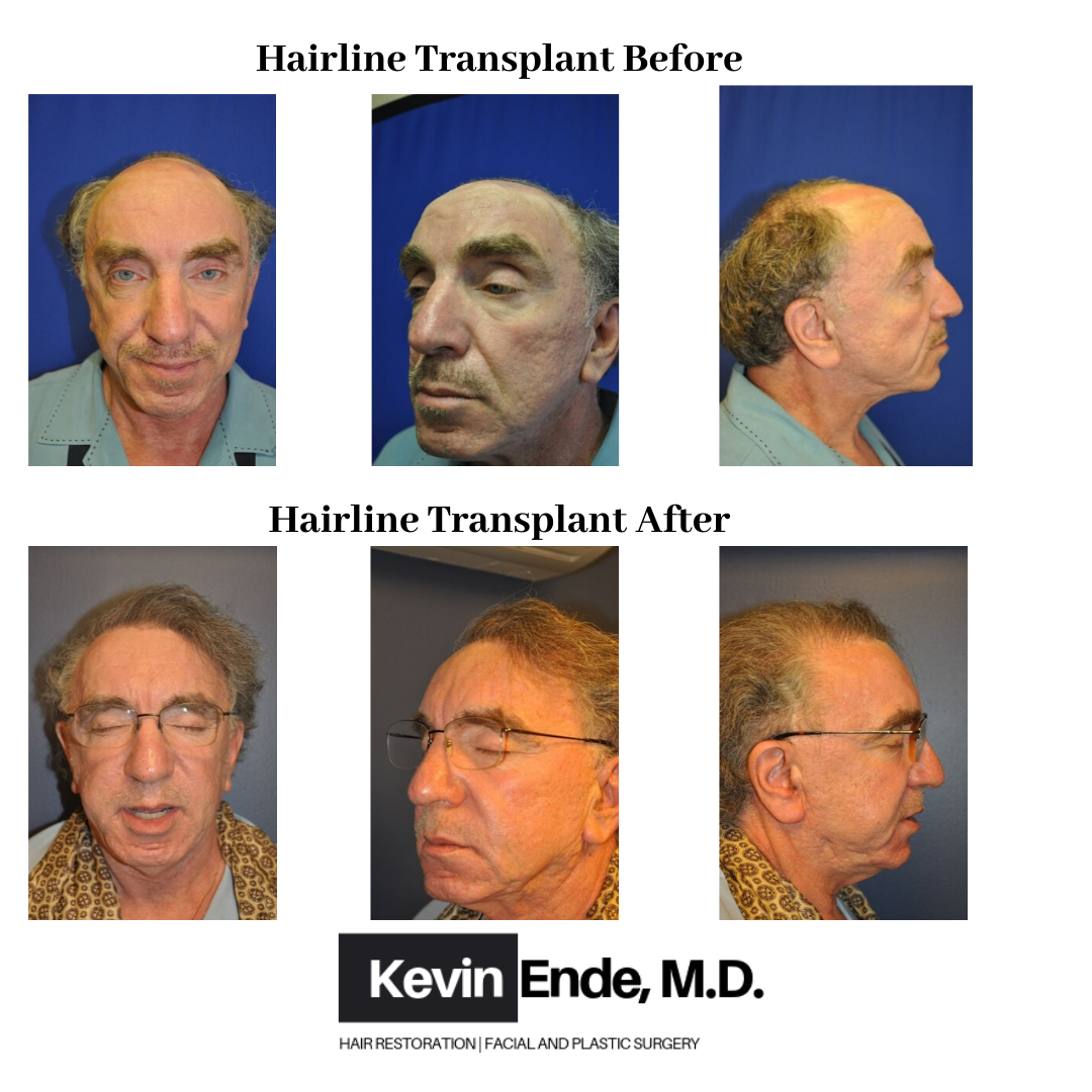 Facelift | Englewood, NJ | Dr. Kevin Ende, M.D.