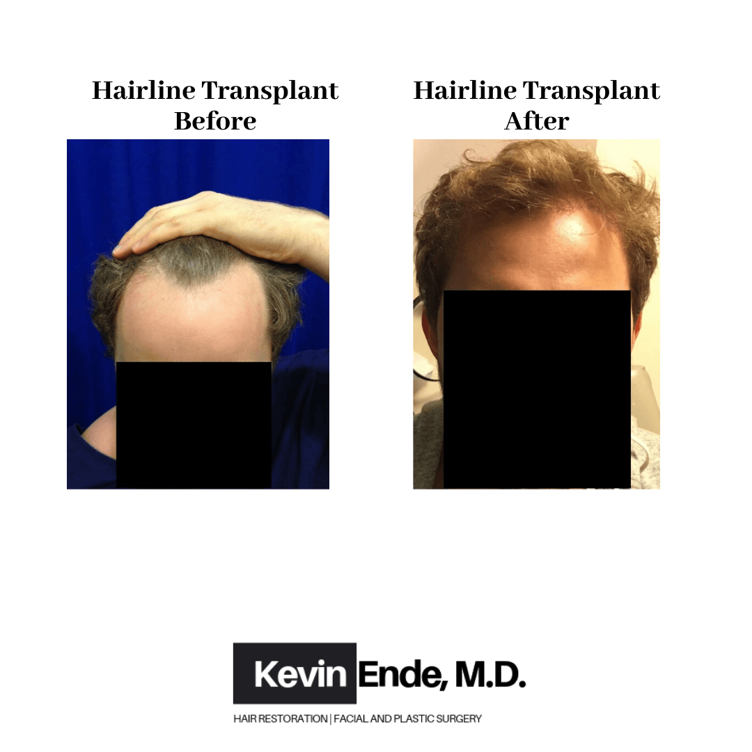 Facelift | Englewood, NJ | Dr. Kevin Ende, M.D.