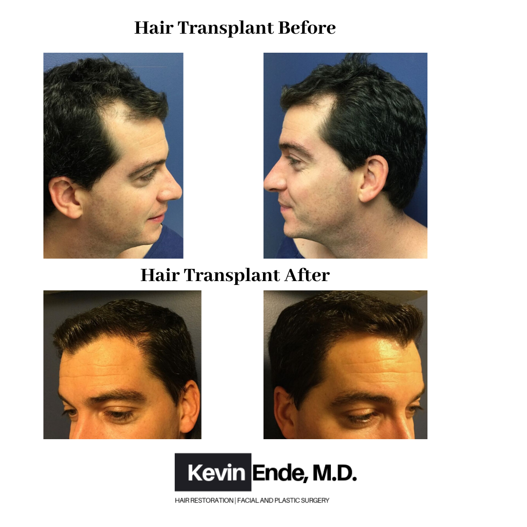 Facelift | Englewood, NJ | Dr. Kevin Ende, M.D.