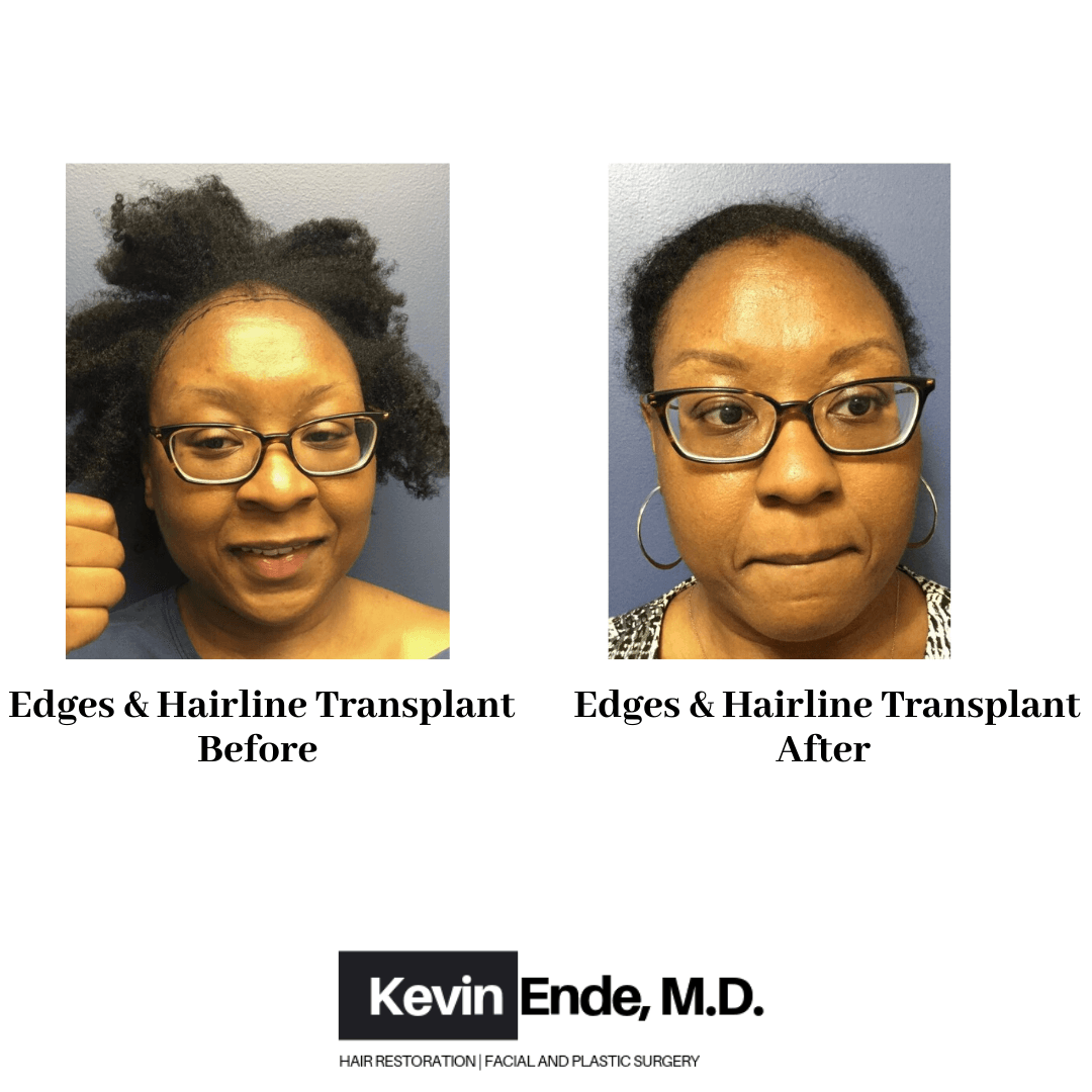 Facelift | Englewood, NJ | Dr. Kevin Ende, M.D.