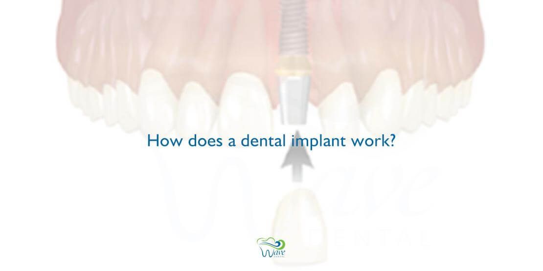 How Does A Dental Implant Work?