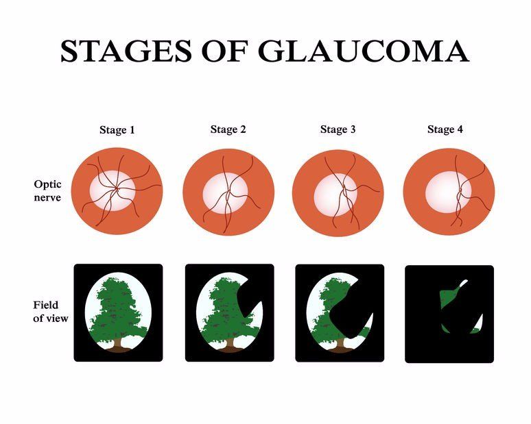 Are You Sure You Don't Have Glaucoma?