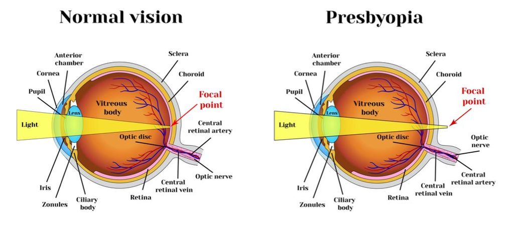 Presbyopia Diagnosis and Treatment | BeSpoke Vision