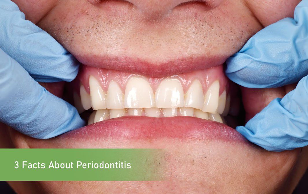 3 Facts About Periodontitis