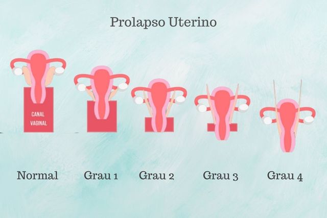 Gravidez Prolapso Uterino Colo Do útero Baixo: O Que é? | Dr.