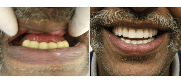 Before & After Smiles | Glen Allen, Va | Dr. Babik & Associates