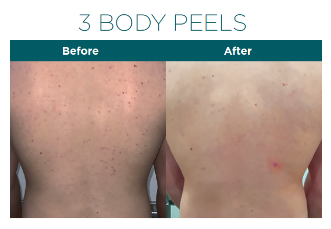 Chemical Peel Treatments for the Back in Grayson, GA - Dermal Knowledge