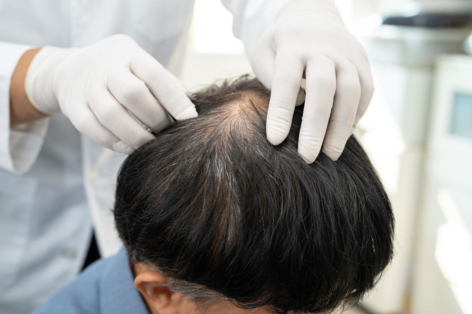 PRP Treatment for Hair Loss & Skin in Malaysia