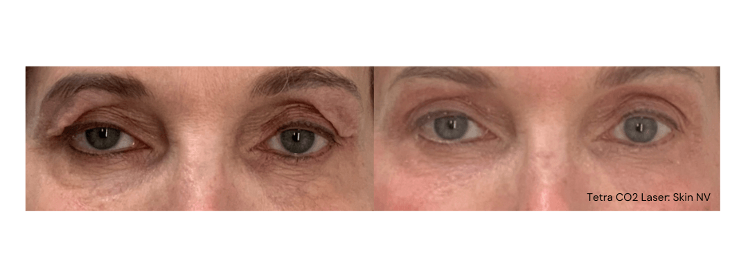 CO2 Laser Skin Resurfacing - Before & After Gallery