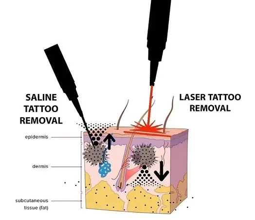 Hypertonic Saline Tattoos Botched Ink ™ Saline Tattoo Brow Removal