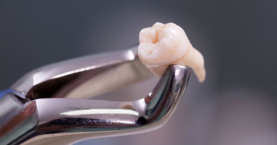 A Step-by-Step Guide on What to Do If You Lose a Tooth