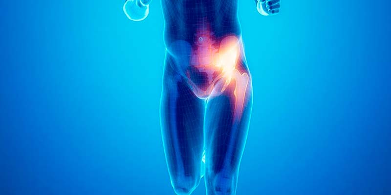 Pubalgia (Or Sports Hernia)