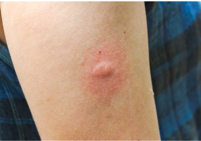 How Long Does Insect Bite Swelling Last - Infoupdate.org