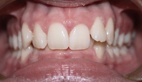 Deep Bite Treatments in Doncaster | E Orthodontics