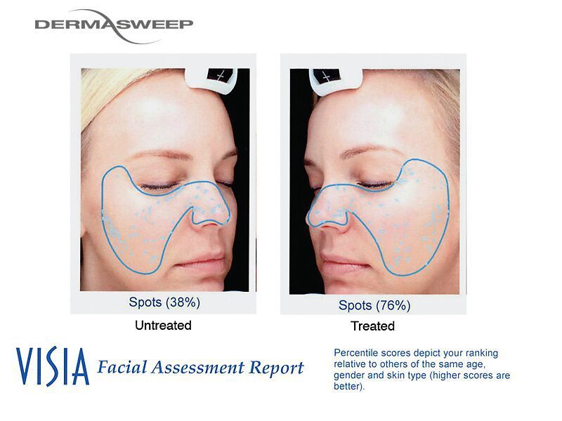 WHAT IS DERMASWEEP SKIN CARE TREATMENT?