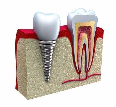 What to Know About Your Singular Tooth Implant