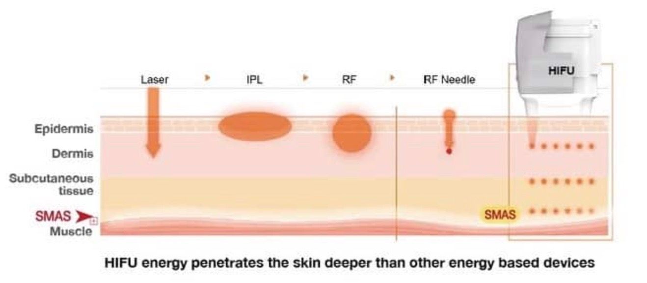 What is HIFU - Your Questions Answered | Hush Clinical Melbourne