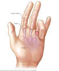 Trigger Finger Release | Orthopaedic Surgeon Queensland | Dr Mwaturura