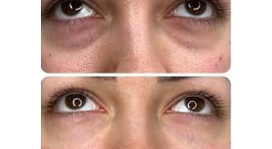 Injectables