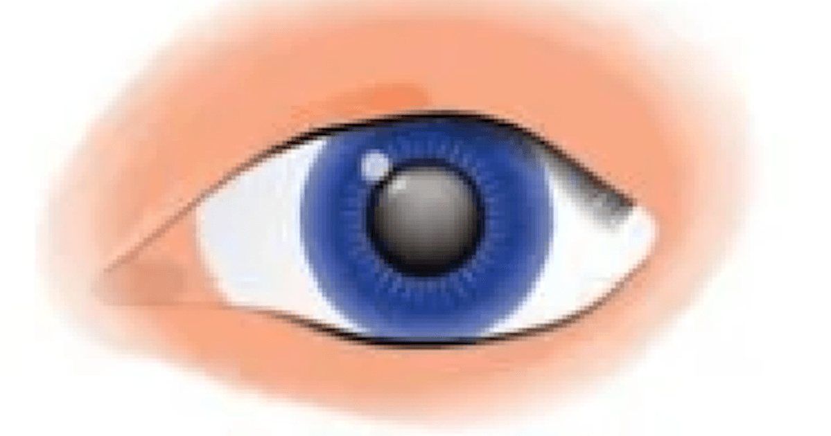 Cataract Tables | Singleton Eye Surgery | Muswellbrook Eye Surgery