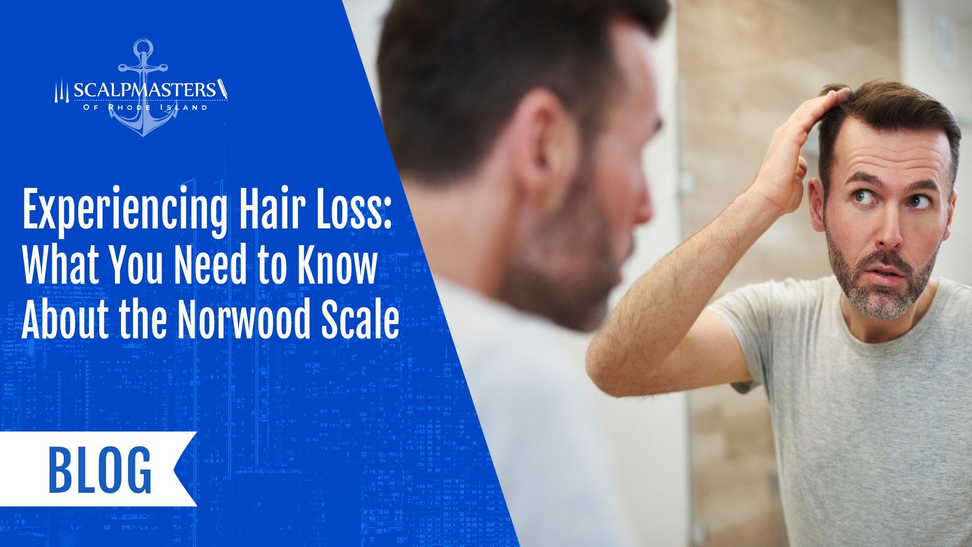 Understand Your Balding Progress on the Norwood Hair Scale