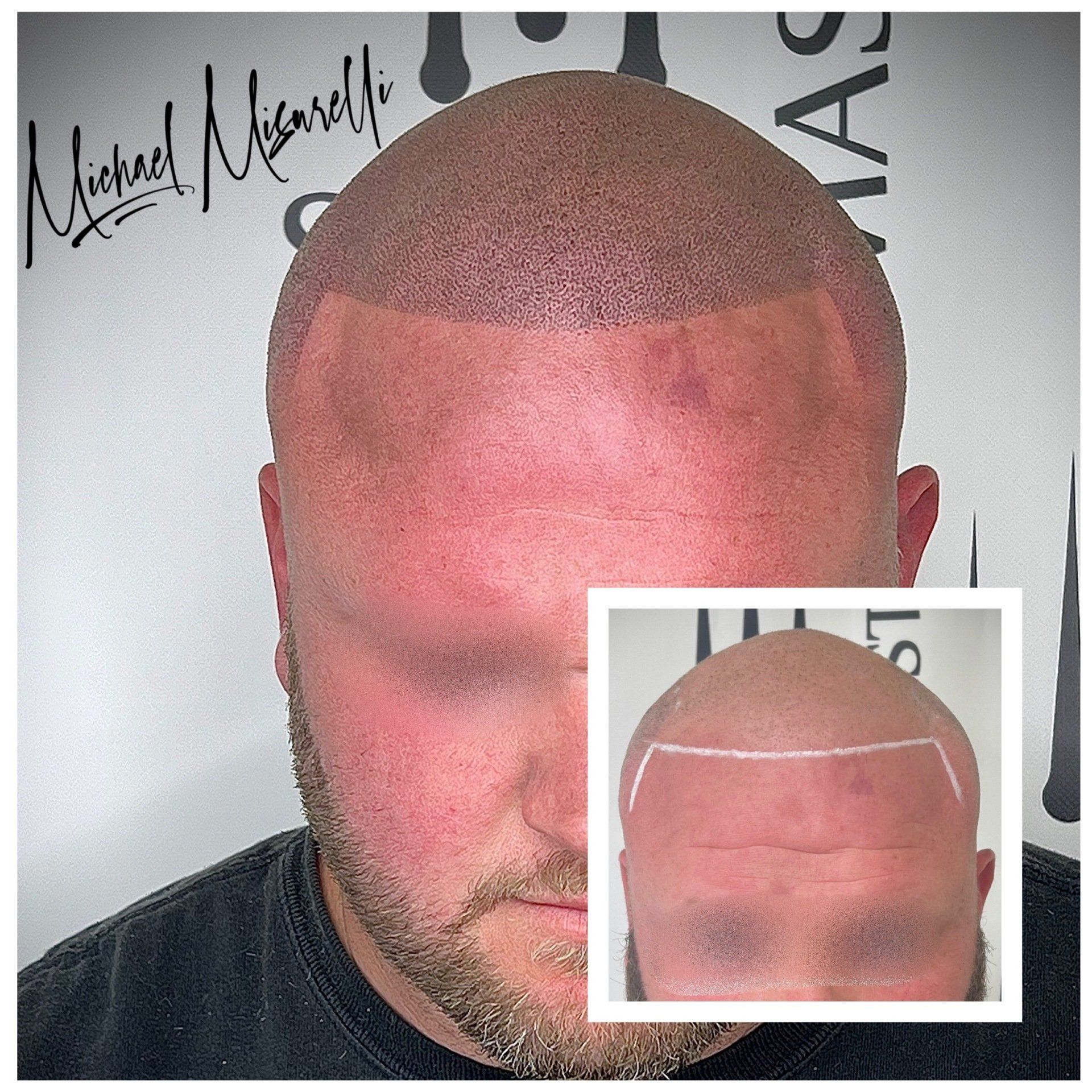 Humira Hair Loss: Can Humira Cause Hair Loss?